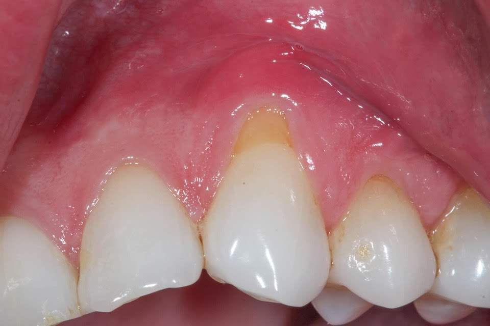 Modified Pin Hole Graft - Kennett Dental Implants